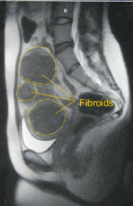 Fibroid Diagnostic Tests – Fibroid Treatment Collaborative
